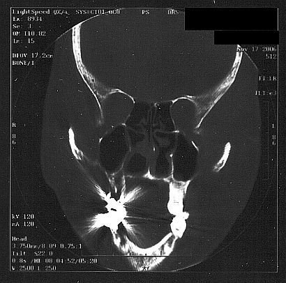 Stuffy Nose - doctor nasal | Ask MetaFilter